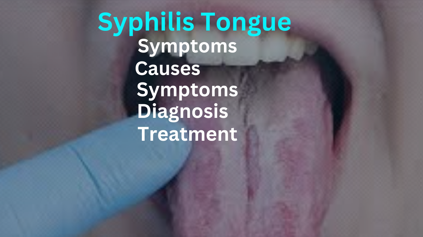 Syphilis Tongue: Symptoms, Causes, Diagnosis, and Treatment - Medical ...
