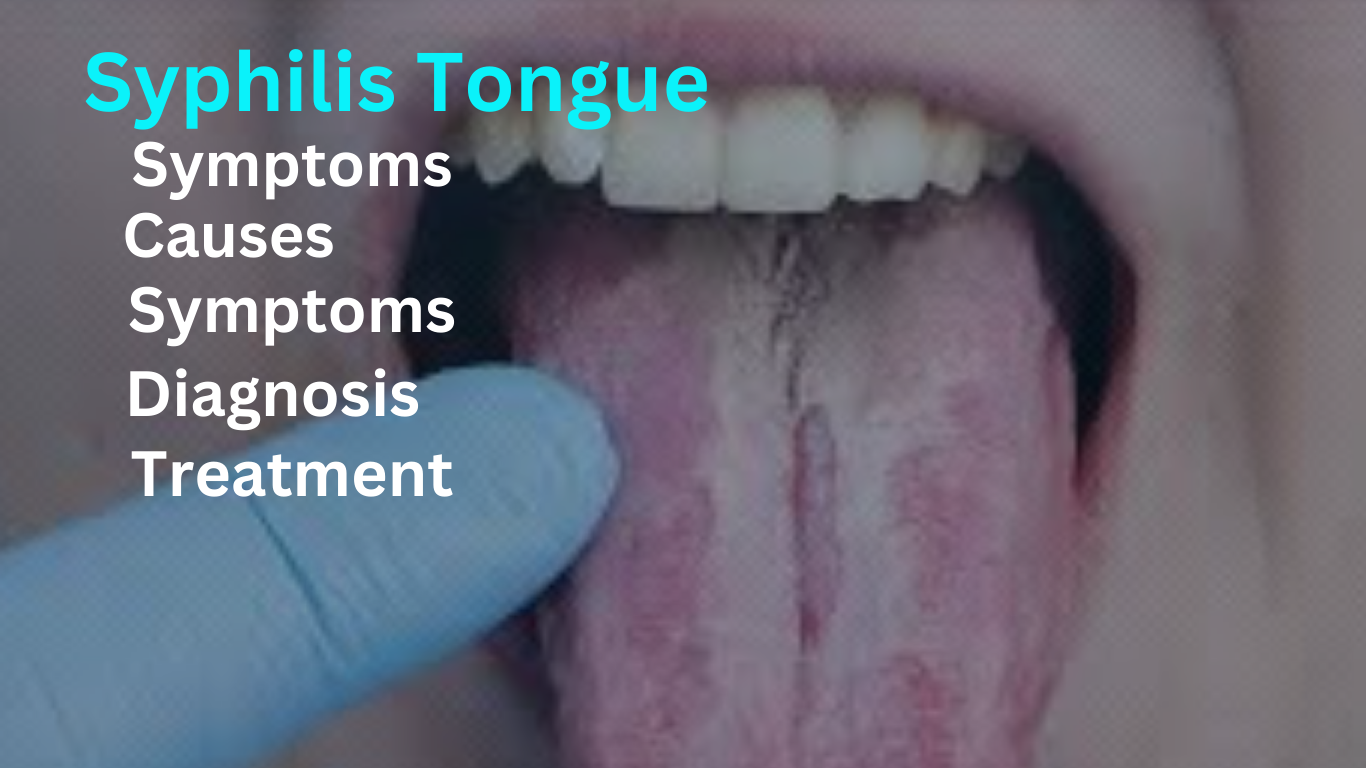 Syphilis Tongue: Symptoms, Causes, Diagnosis, and Treatment - Medical ...